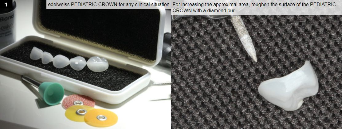 edelweiss dentistry Paediatric Crowns - Dental Practice Systems