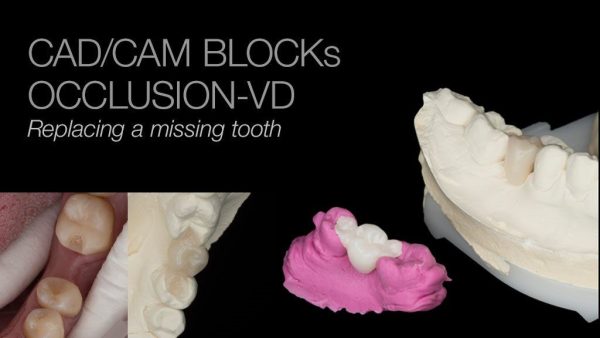 Replacing a missing tooth with edelweiss OCCLUSION-VDs & CAD/CAM BLOCKs ...